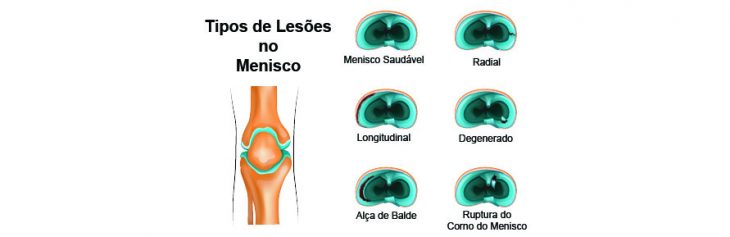 Tratamento Fisioterapêutico das Lesões de Menisco
