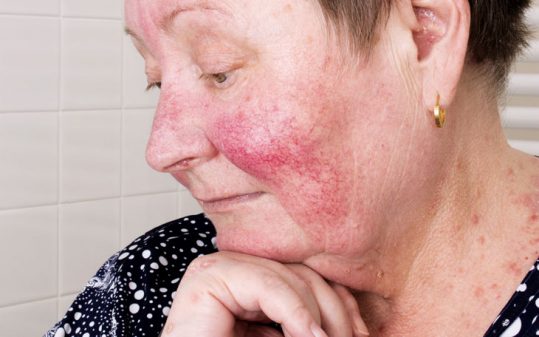 Entenda Tudo Sobre o Tratamento Fisioterapêutico da Dermatomiosite