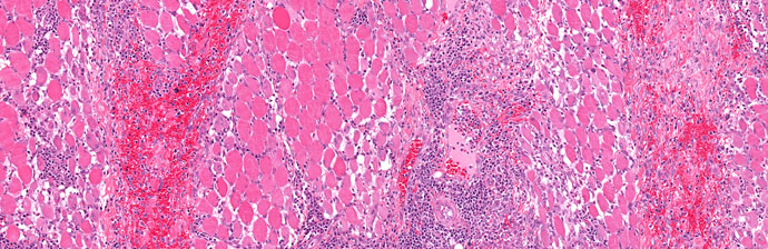 Entenda Tudo Sobre o Tratamento Fisioterapêutico da Dermatomiosite