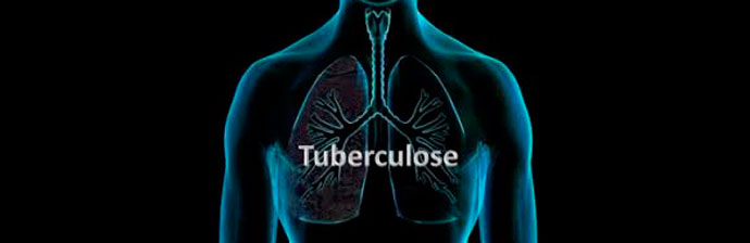 Saiba o que é Tuberculose e Como a Fisioterapia Auxilia no Tratamento