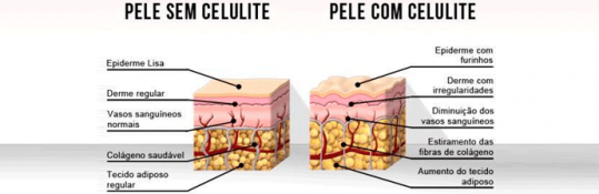 O Que é Celulite? Saiba como Tratá-la da Maneira Correta O Que é Celulite? Saiba como Tratá-la da Maneira Correta