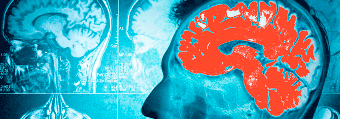 Tudo que Você precisa Saber sobre Síndrome Pós-Pólio