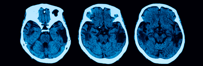 Papel do Fisioterapeuta na Reabilitação de Pacientes com AVC